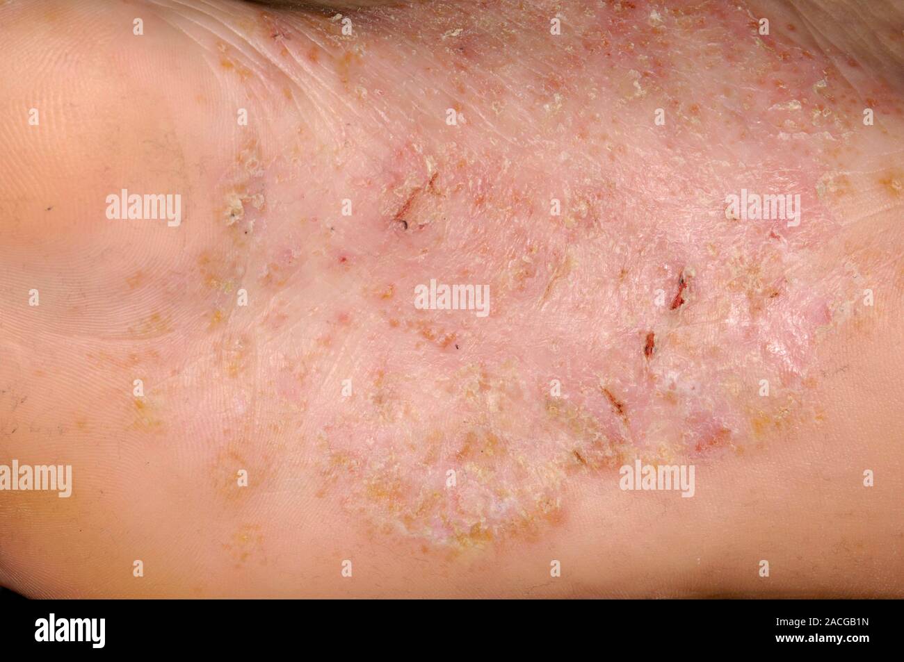 Infected eczema on the foot of a 49 year old male patient. Eczema is ...