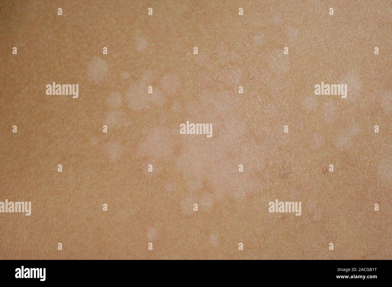 Pityriasis versicolor of the skin in an 18 year old female patient ...