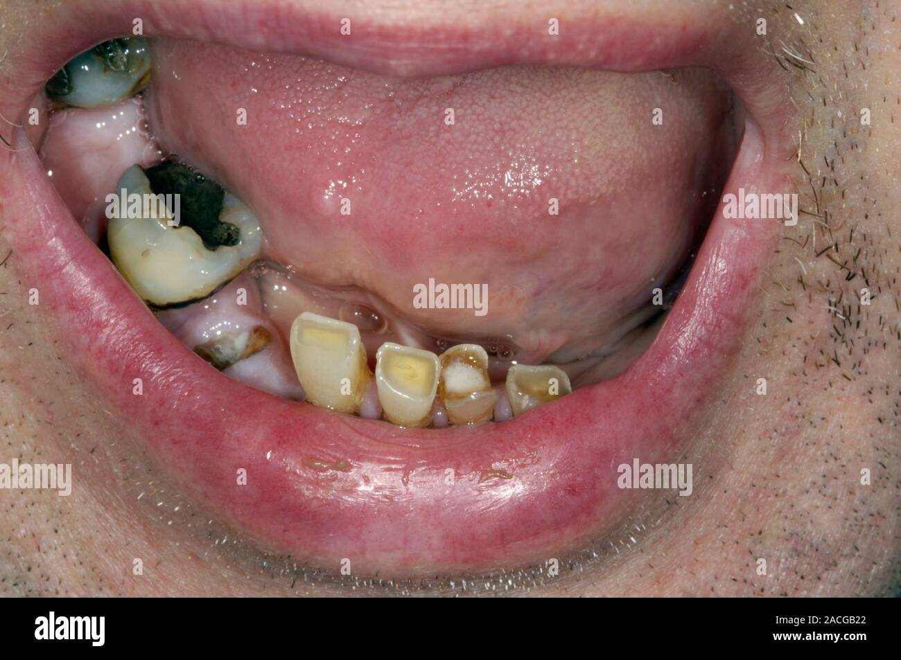 Close-up of the lower jaw of the mouth of a 63 year old male patient ...