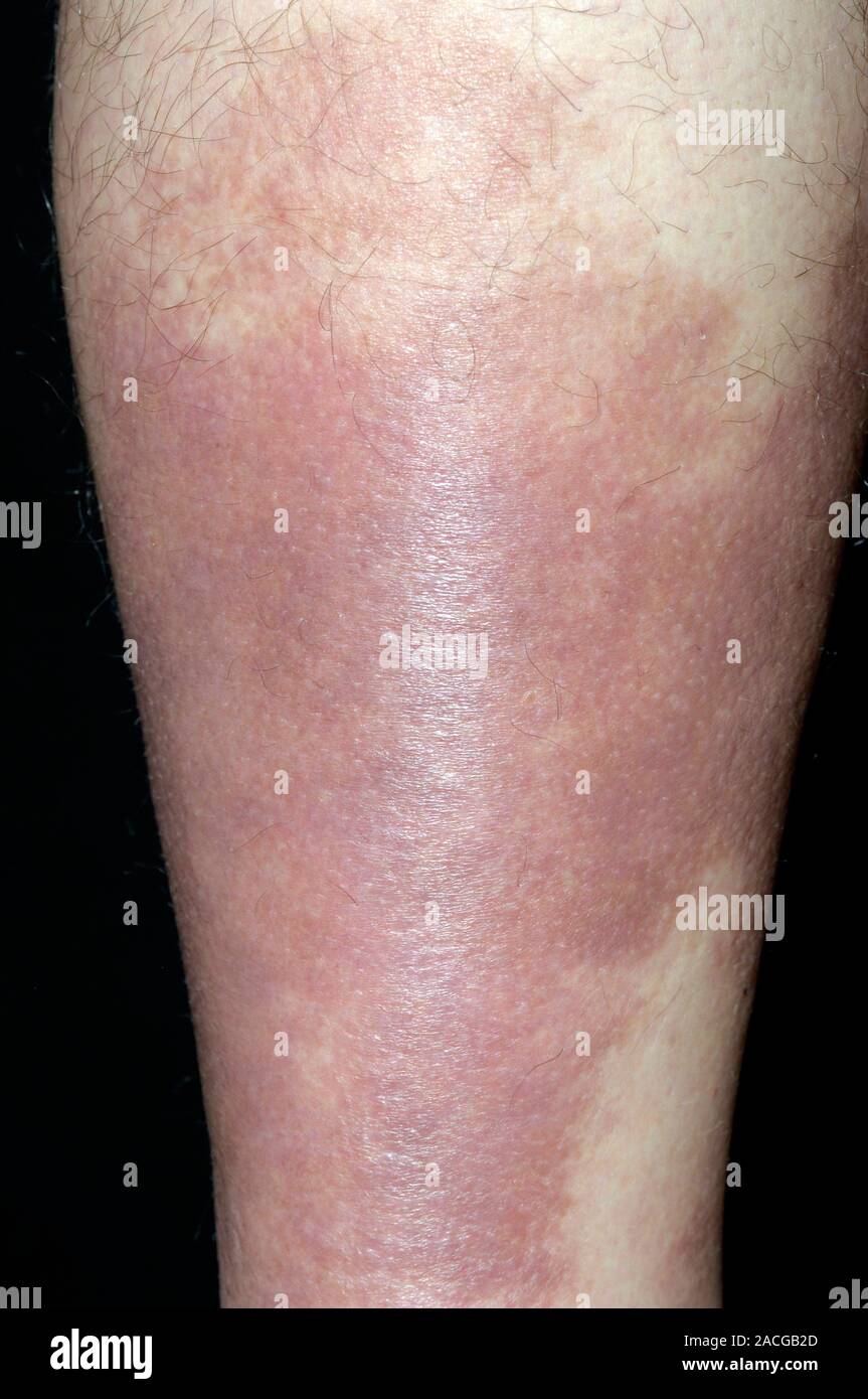 Pigmentation and oedema (fluid retention and swelling) after cellulitis ...