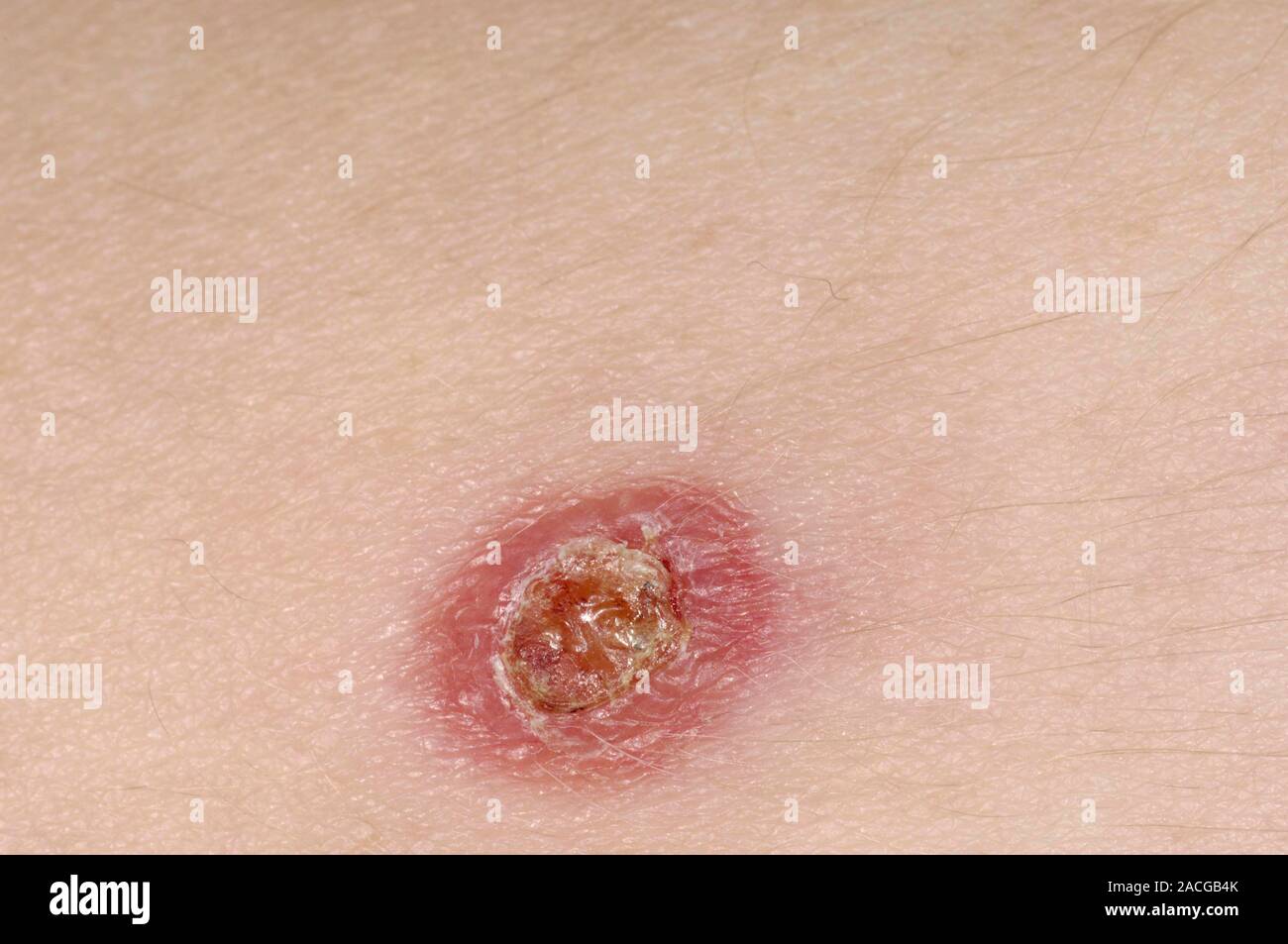 Close-up of a papule forming a scar on the skin in an 8 year old male ...