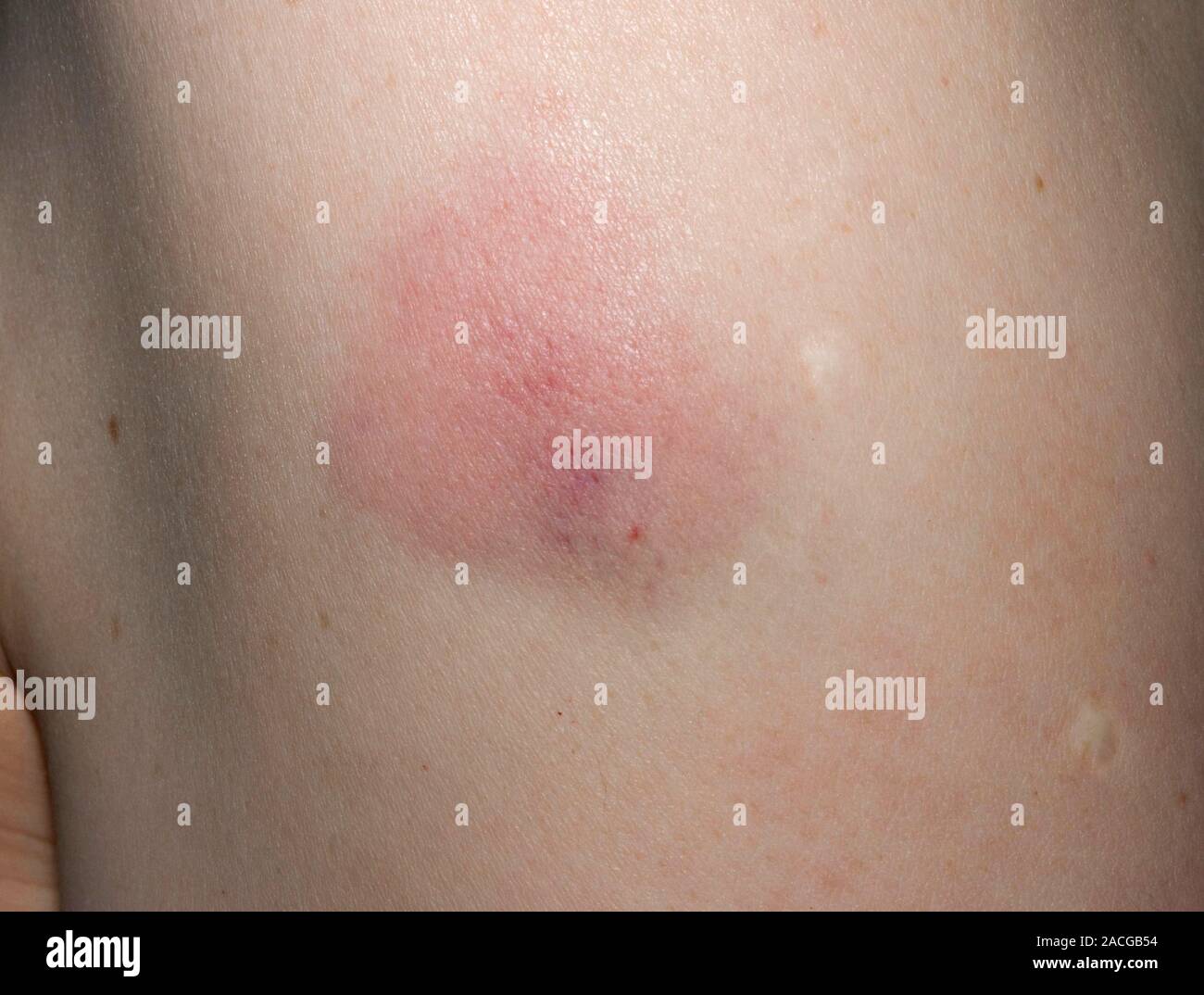 Close-up of bruising and swelling of the skin in a 48 year old female ...