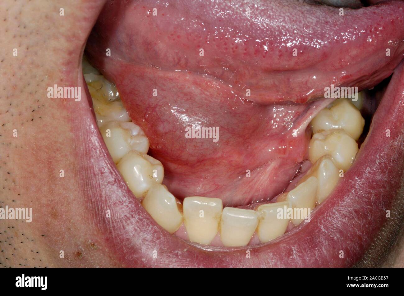 Close-up of the mouth in a 34 year old male patient, showing a swollen ...