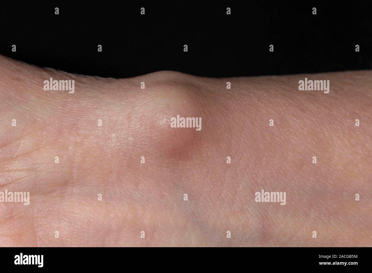 Close-up of a ganglion on the wrist of a 73 year old female patient ...