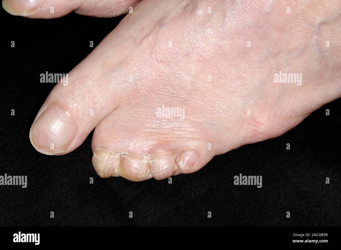 Foot of a 66 year old female patient showing congenital (present from ...