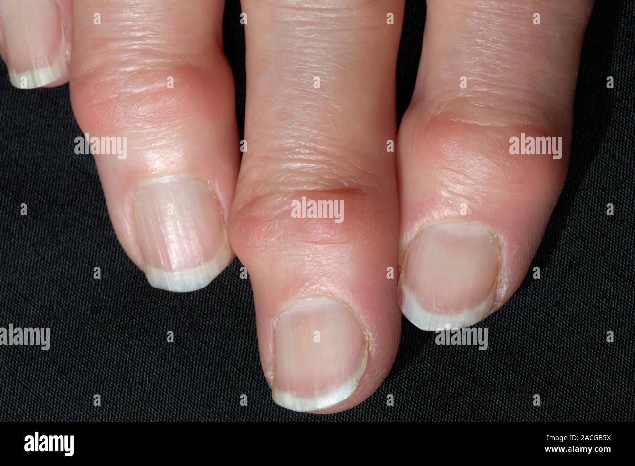 Deformed fingers of the hand in a 65 year old female patient due to ...