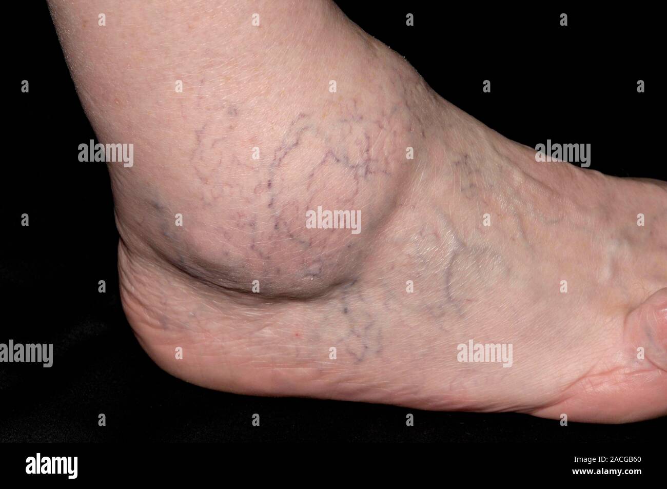 Side view of the deformed ankle of the foot in a 71 year old male ...