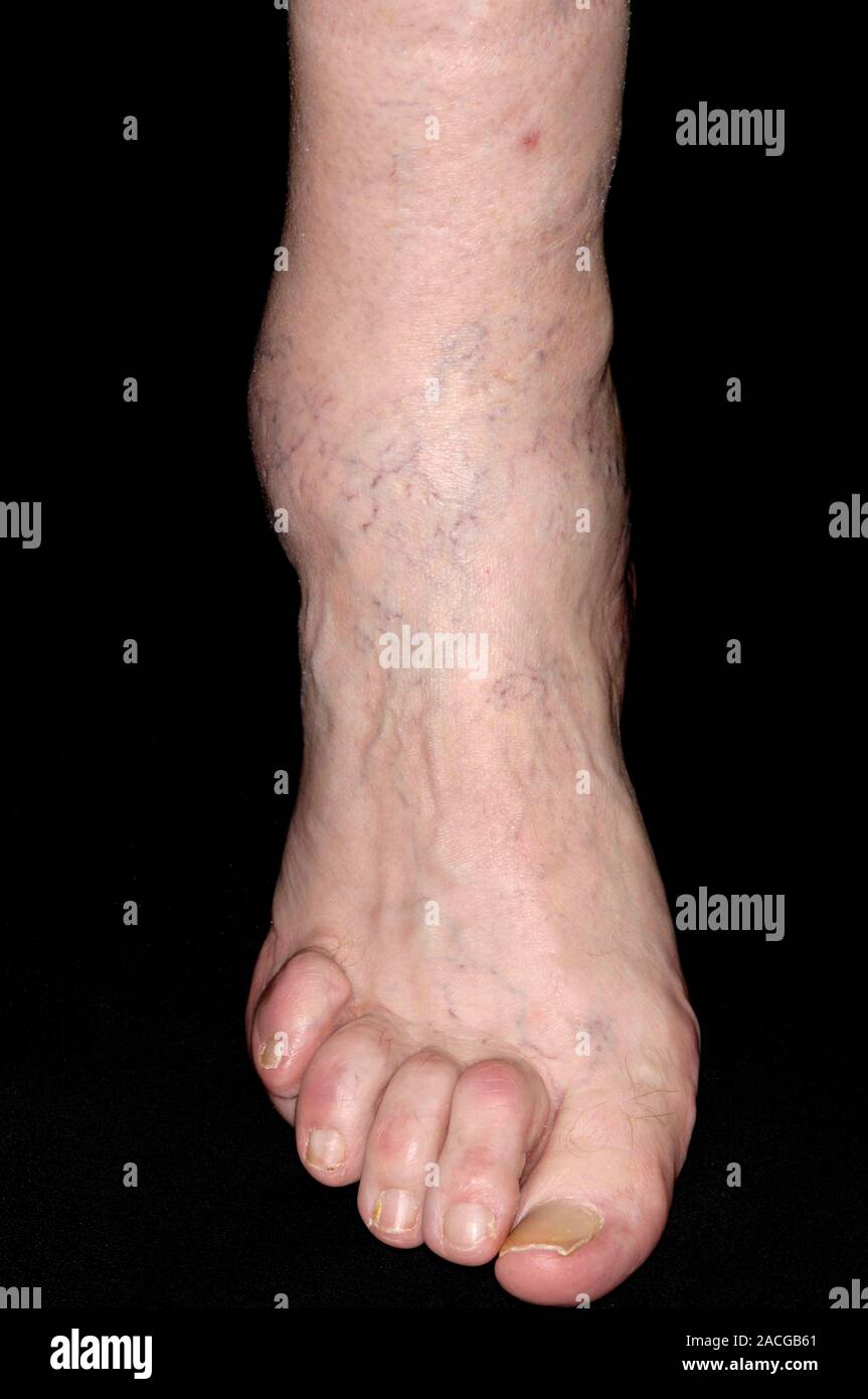 Front view of the deformed ankle of the foot in a 71 year old male ...