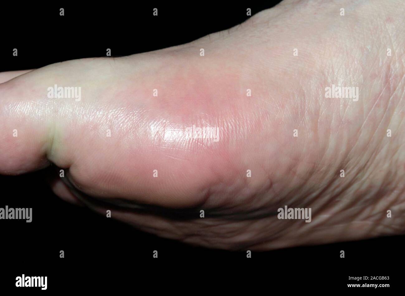 Redness around the joint showing acute gout of the big toe in an 81 ...