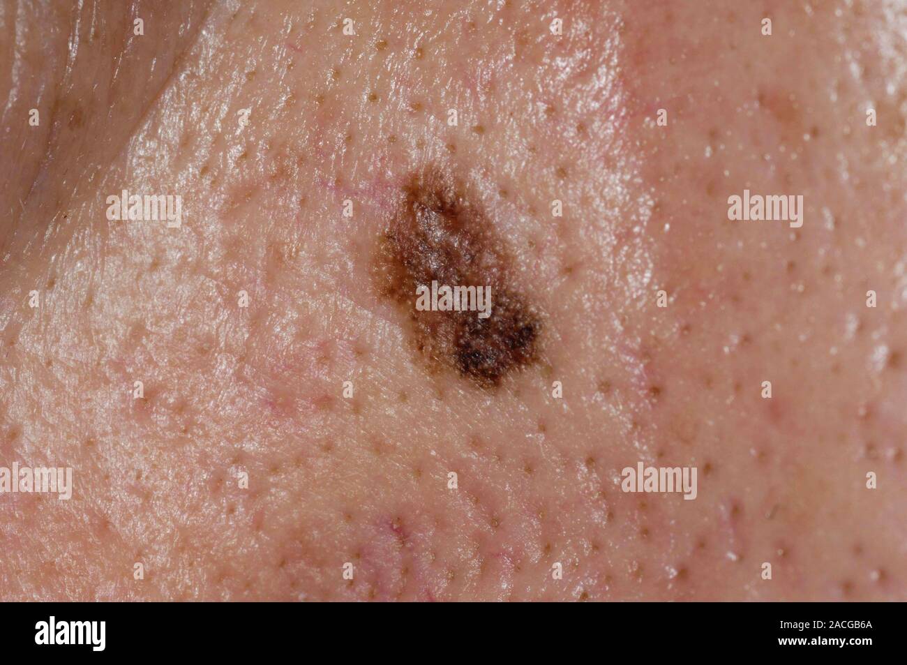 Close-up of lentigo maligna on the side of the nose in a 62 year old ...