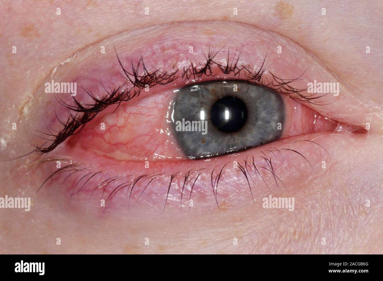 Close-up of the pink and inflamed eye in a 28 year old female patient ...
