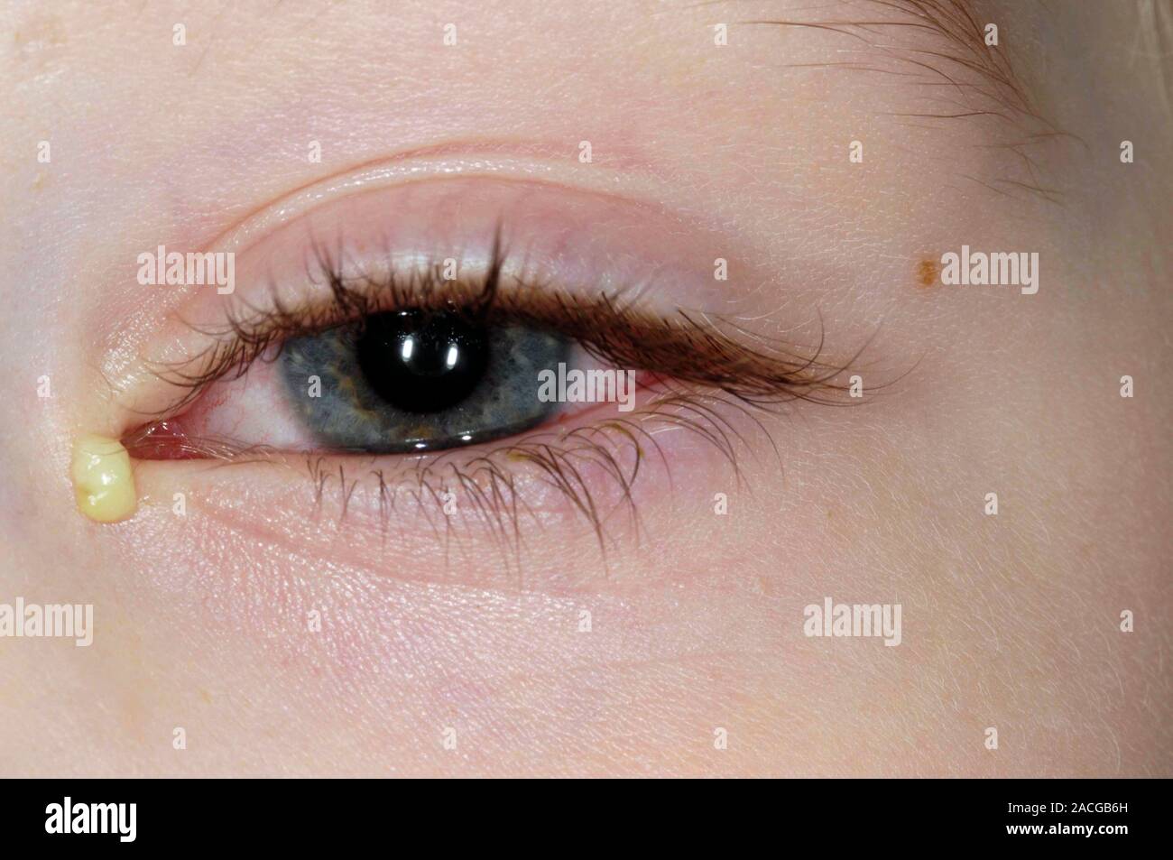 Close-up of the eye in a 4 year old male patient, showing acute ...