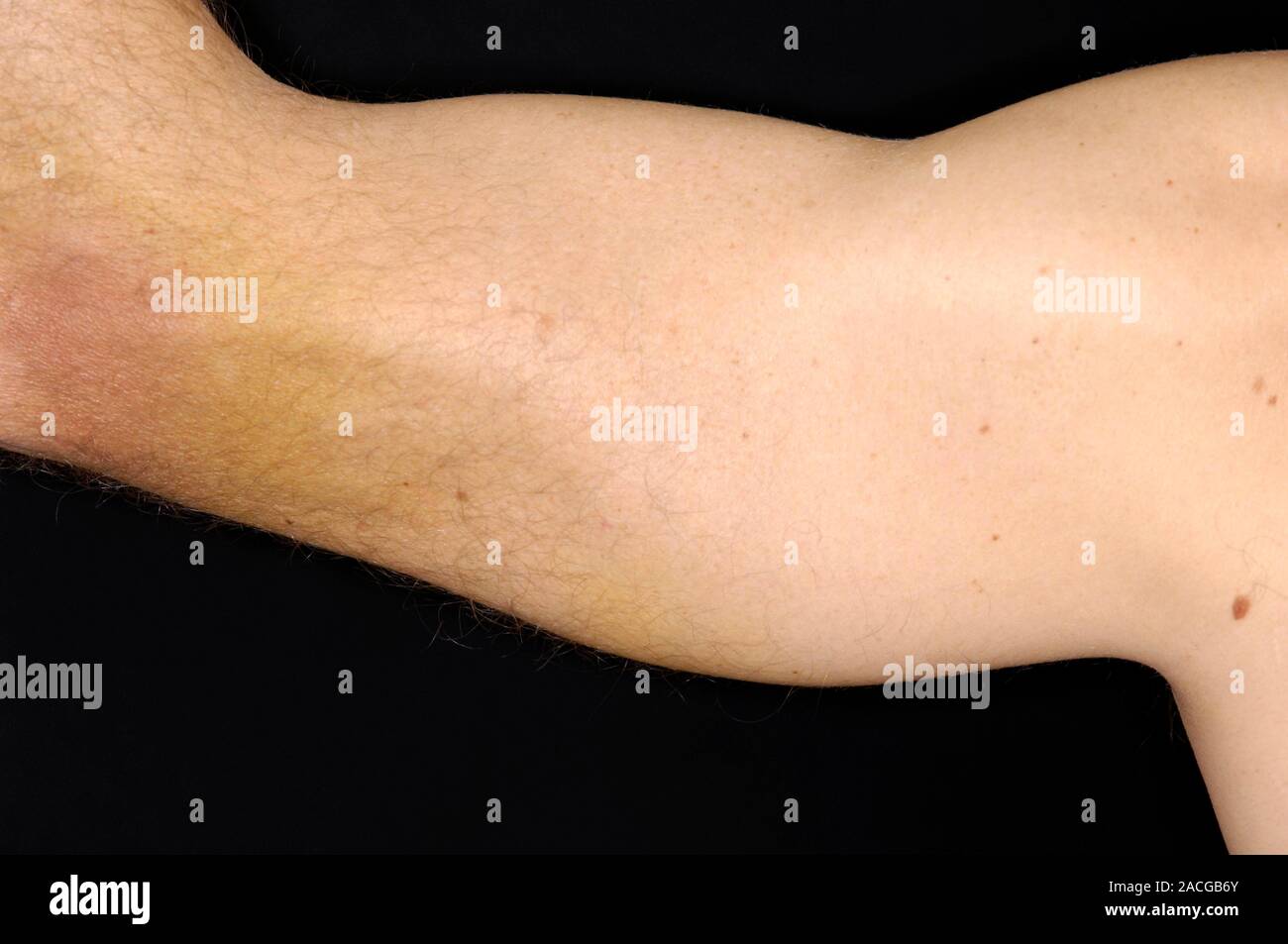 Torn triceps muscle of the arm in a 53 year old male patient, which ...