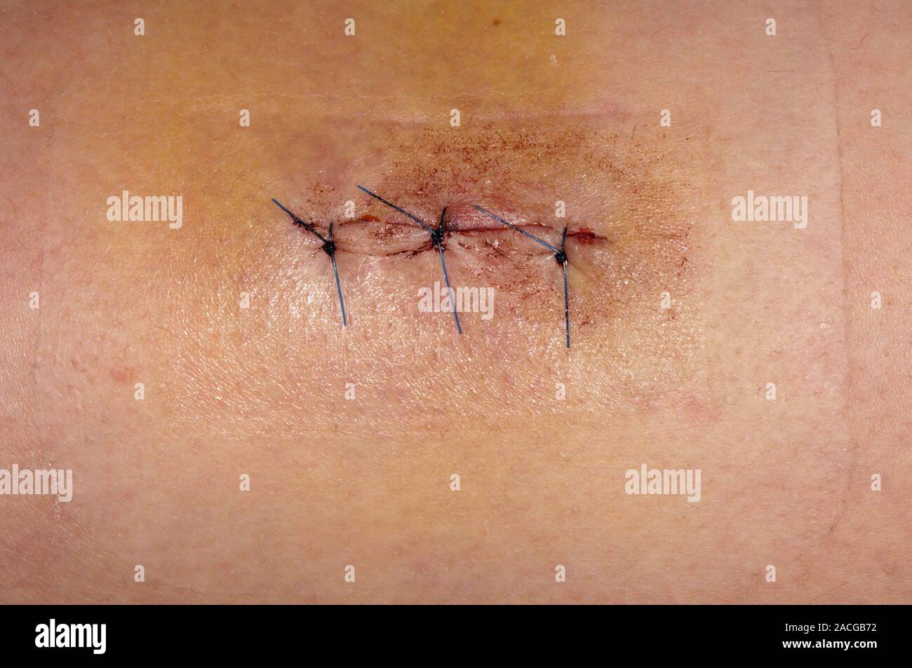 Sutured wound on the thigh of a 28 year old female patient, after a ...