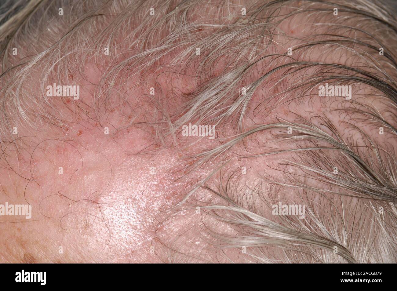 Irritation of the scalp in an 81 year old male patient, after a ...