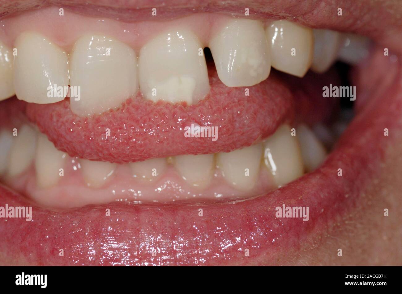 Squamous cell papilloma lesion on the tongue of a 37 year old female ...