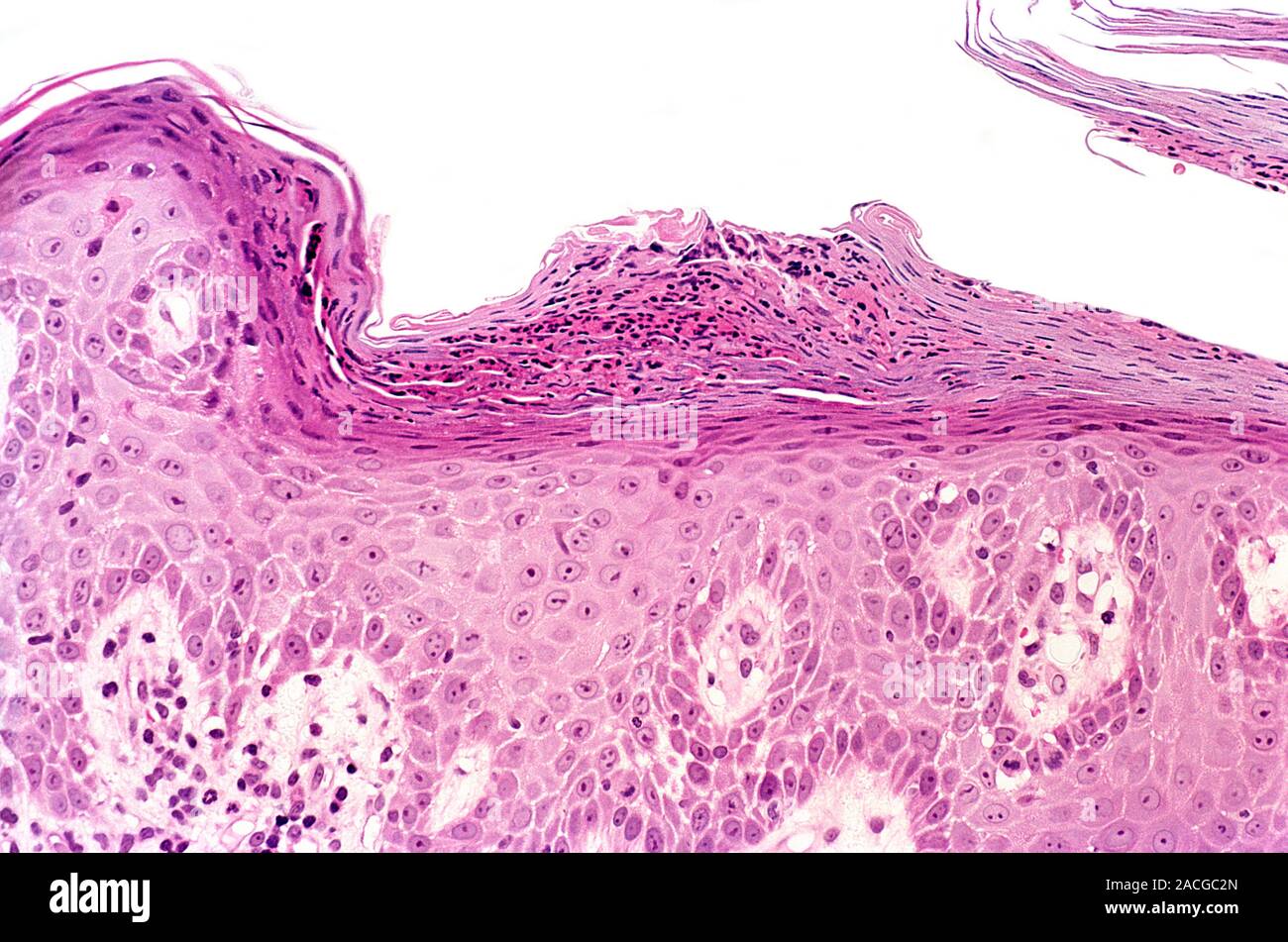 Psoriasis. Light micrograph of a section through skin affected by ...