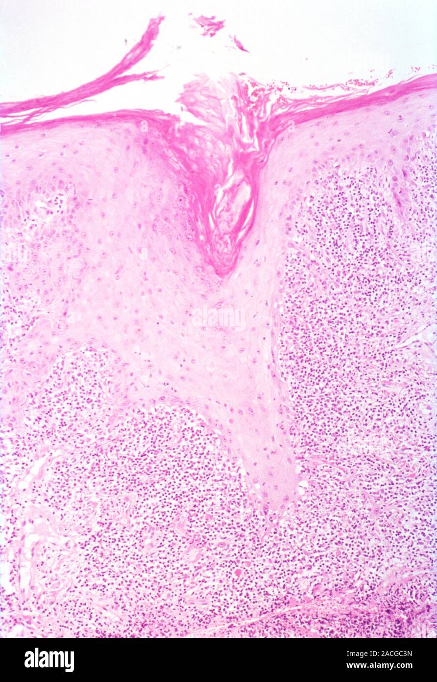 Lichen planus. Light micrograph of a section through skin affected by ...