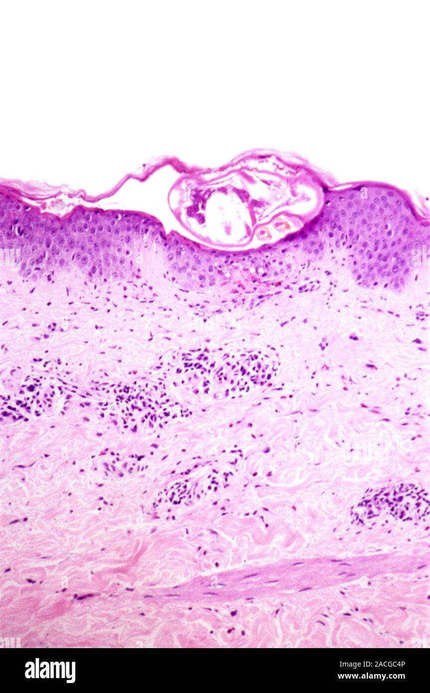 Psoriasis. Light micrograph of a section through skin affected by ...