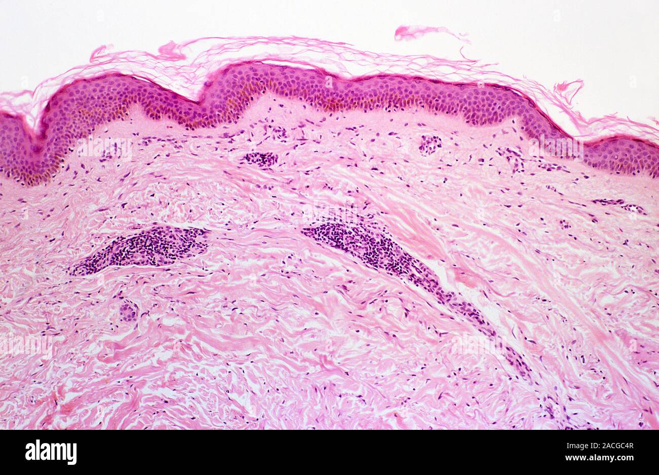 Psoriasis. Light micrograph of a section through skin affected by ...
