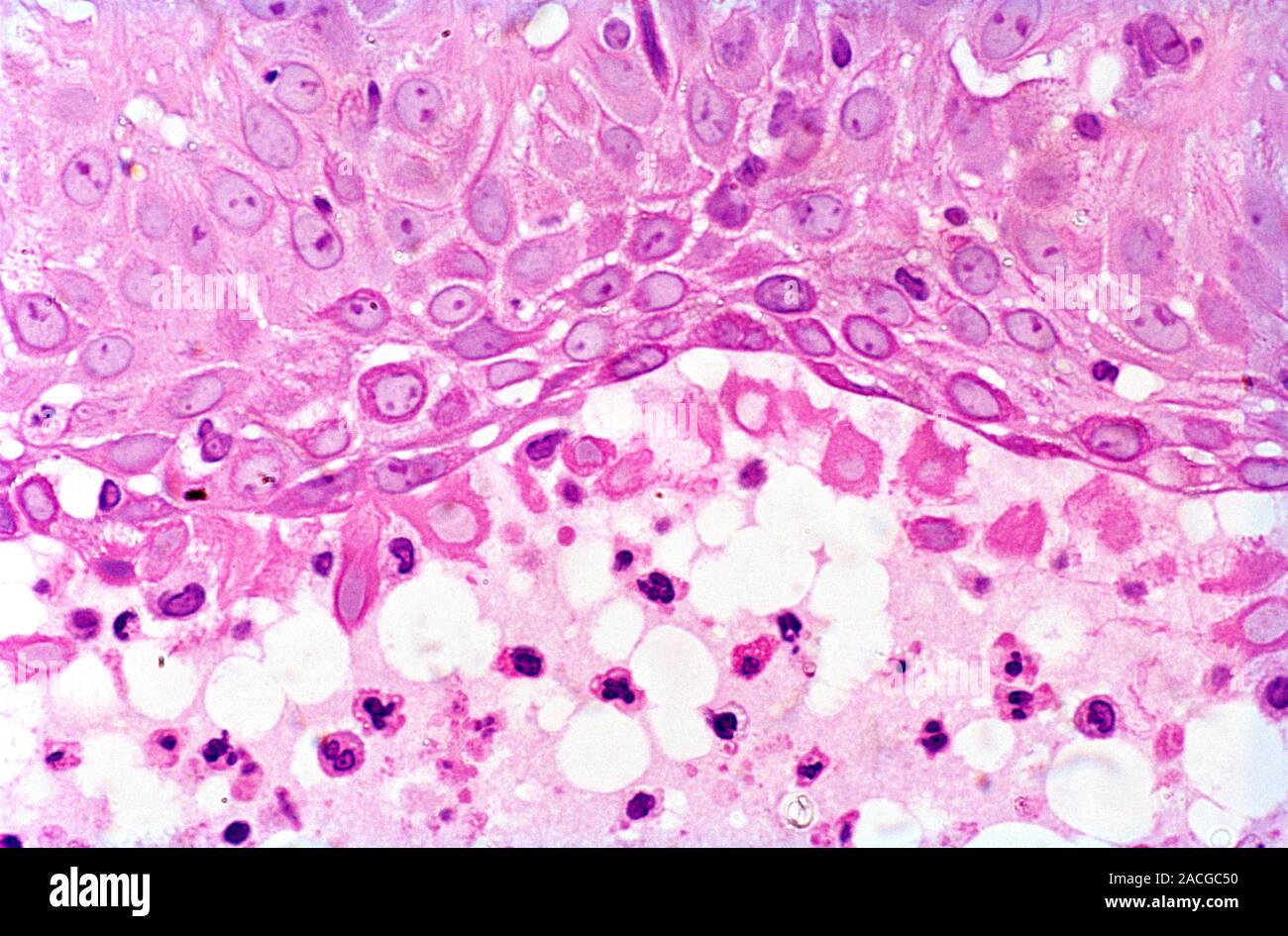 Chronic dermatitis. Light micrograph of a section through skin affected ...