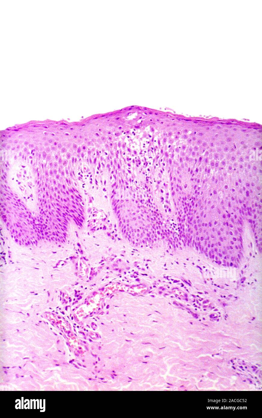 Chronic dermatitis. Light micrograph of a section through skin affected ...