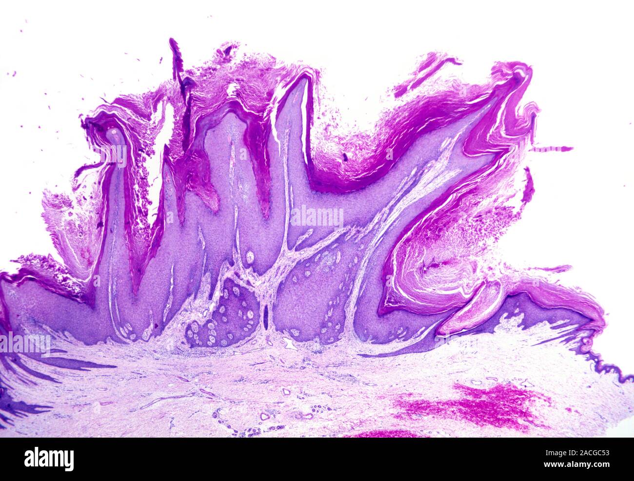 Viral wart. Light micrograph of a section through a wart caused by a ...