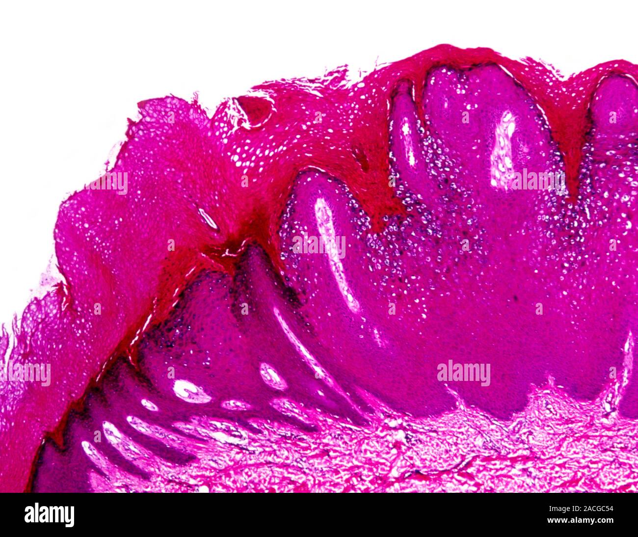 Viral wart. Light micrograph of a section through a wart caused by a ...
