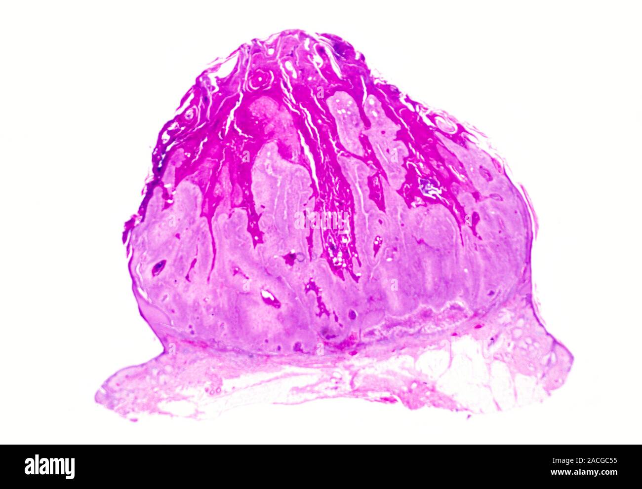 Keratoacanthoma. Light micrograph of a section through a ...