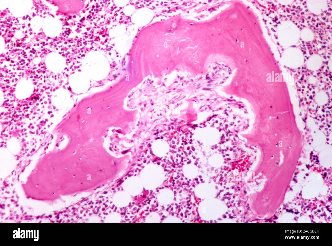 Rheumatoid arthritis. Light micrograph of a section through a ...