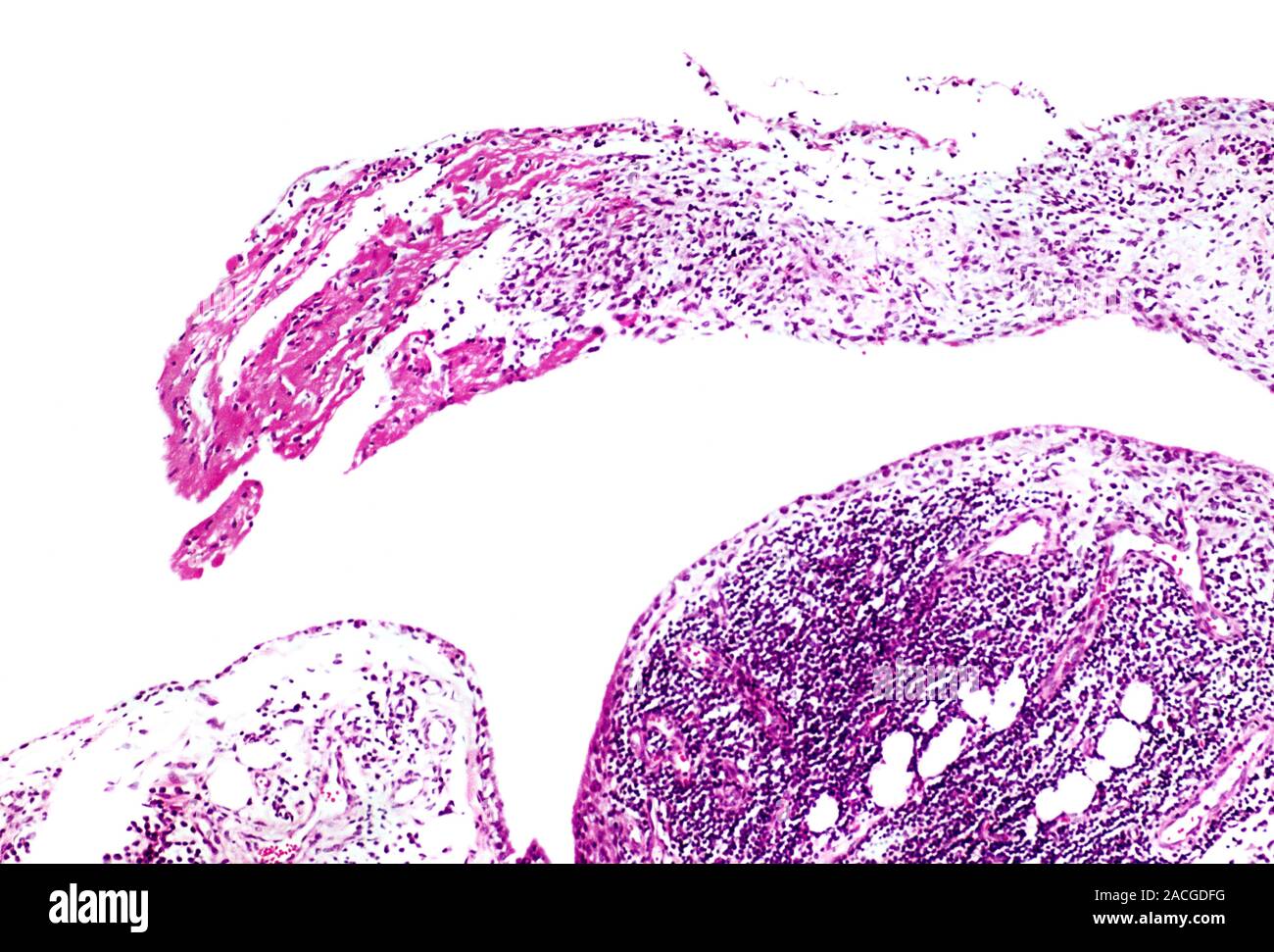 Rheumatoid arthritis. Light micrograph of a section through the ...