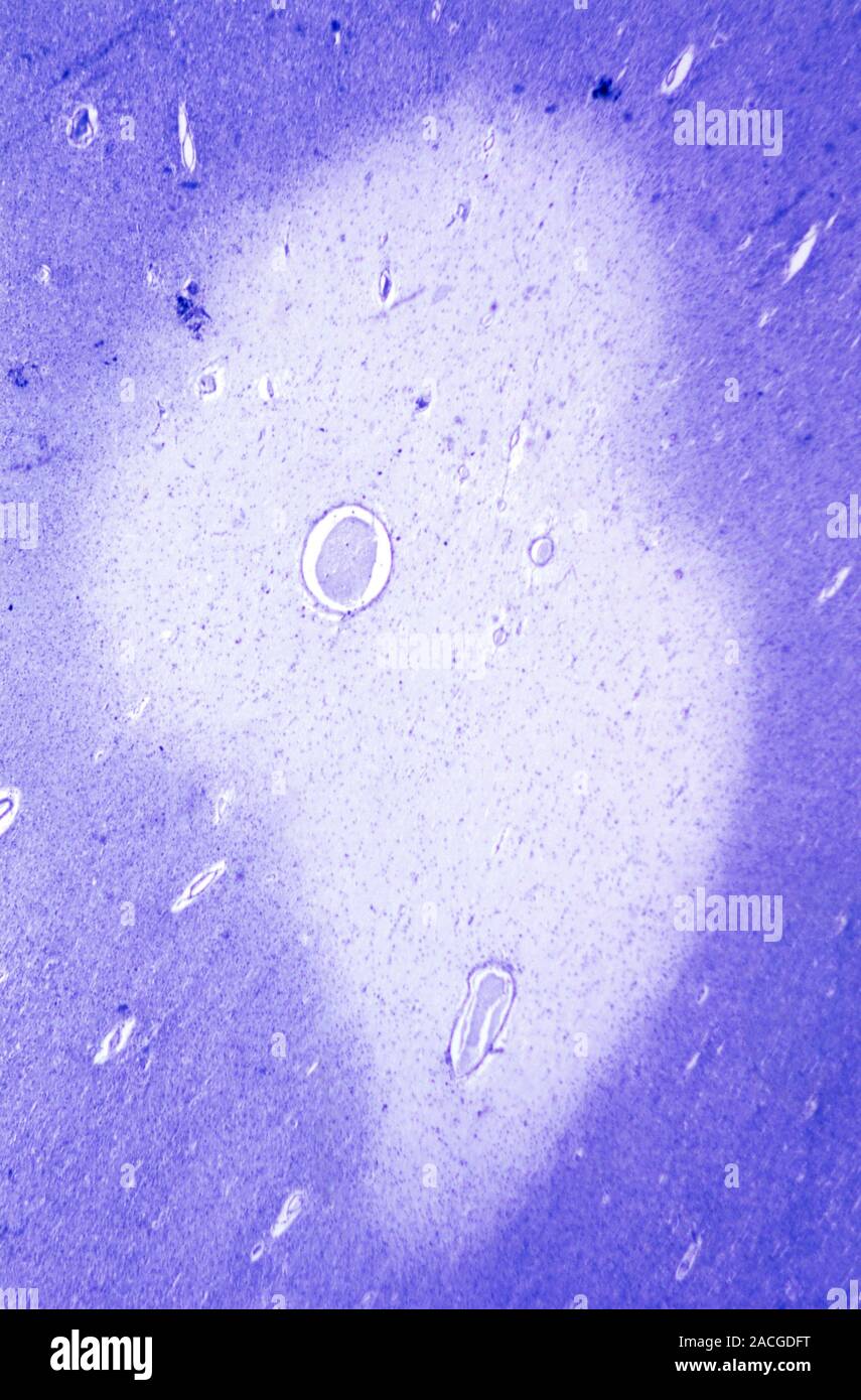 Multiple sclerosis. Light micrograph of a section through white matter ...