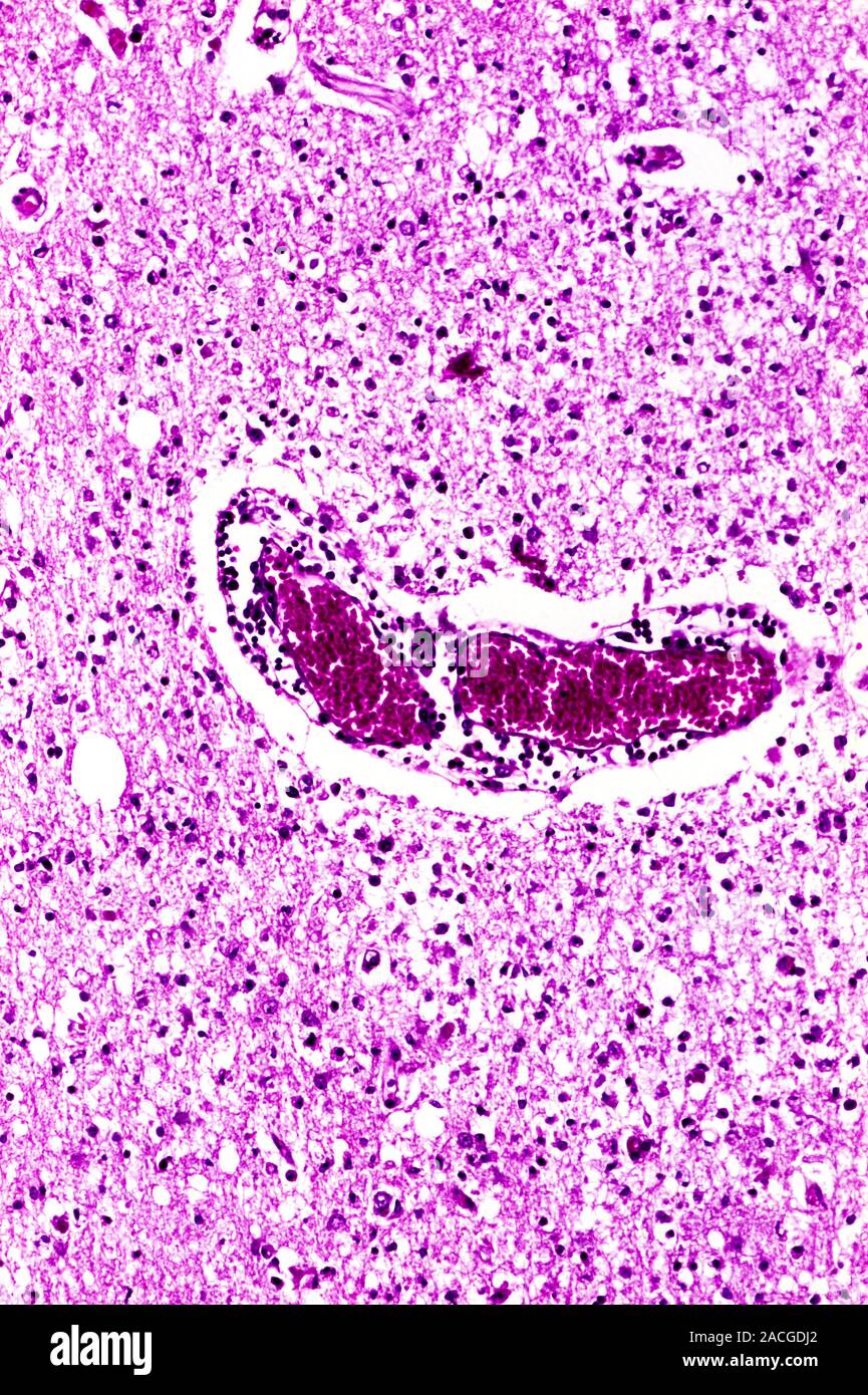 Herpes encephalitis. Light micrograph of a section through brain tissue ...
