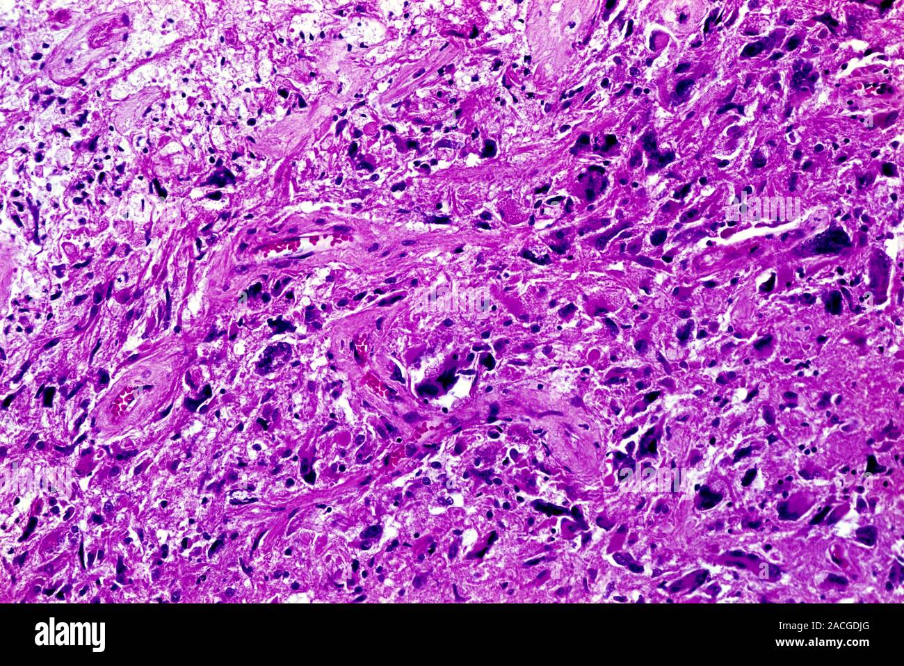 Glioblastoma brain tumour. Light micrograph of a section through a ...