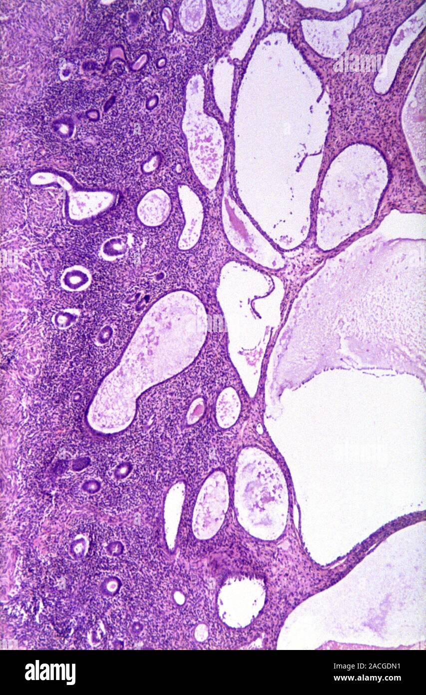 Uterine cancer. Light micrograph of a section through tissue from the ...