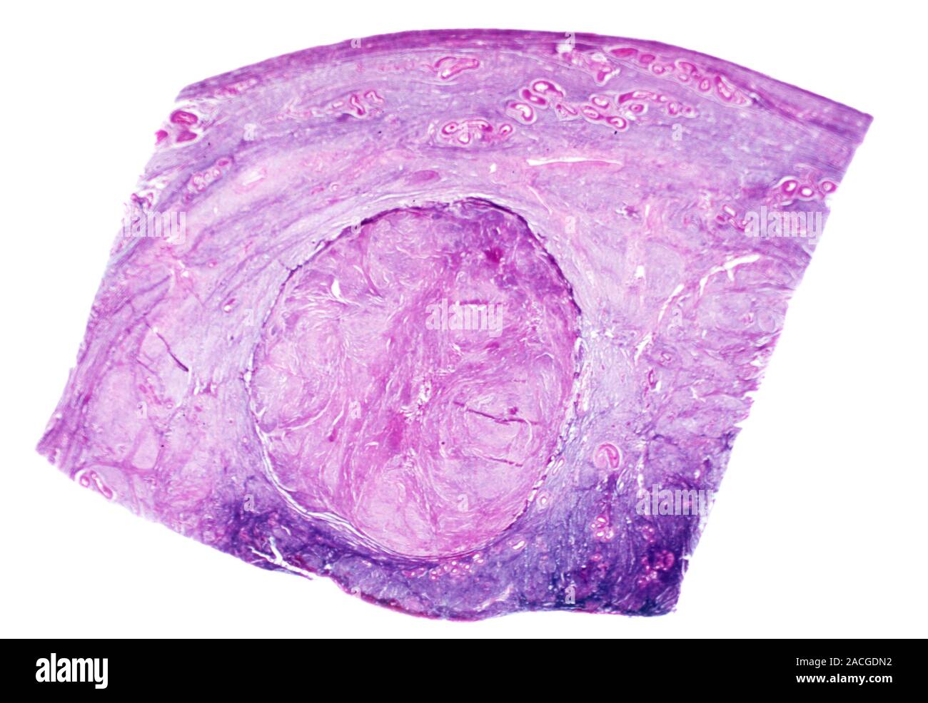 Uterine fibroid. Light micrograph of a section through tissue from the ...