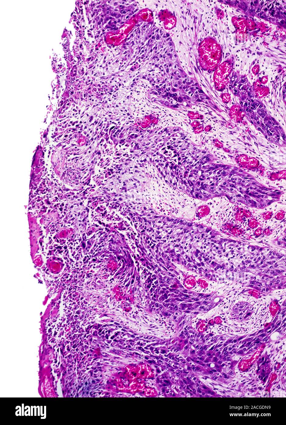 Invasive cervix cancer. Light micrograph of a section through tissue ...