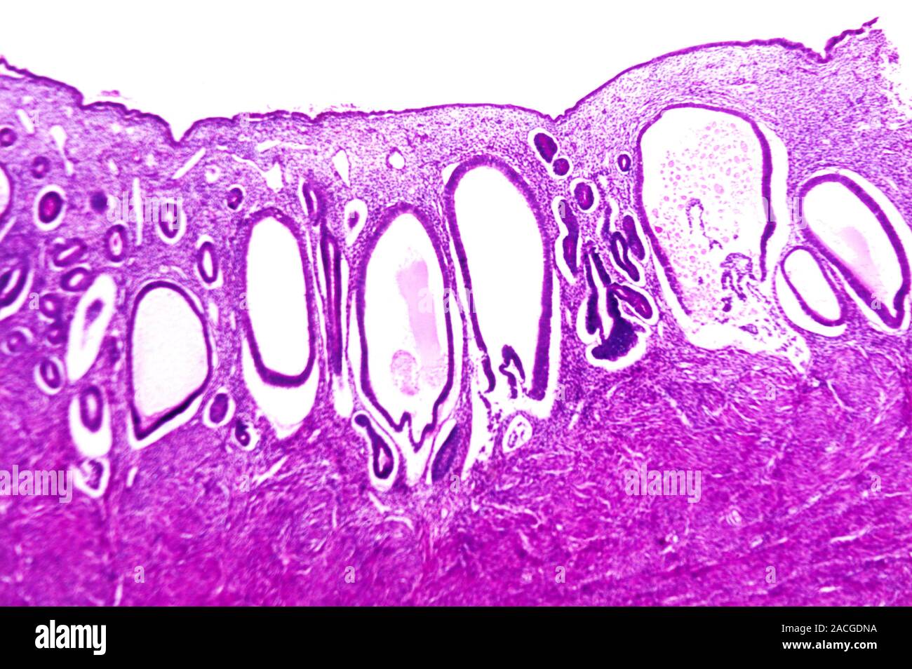 Endometrial hyperplasia. Light micrograph of a section through tissue ...