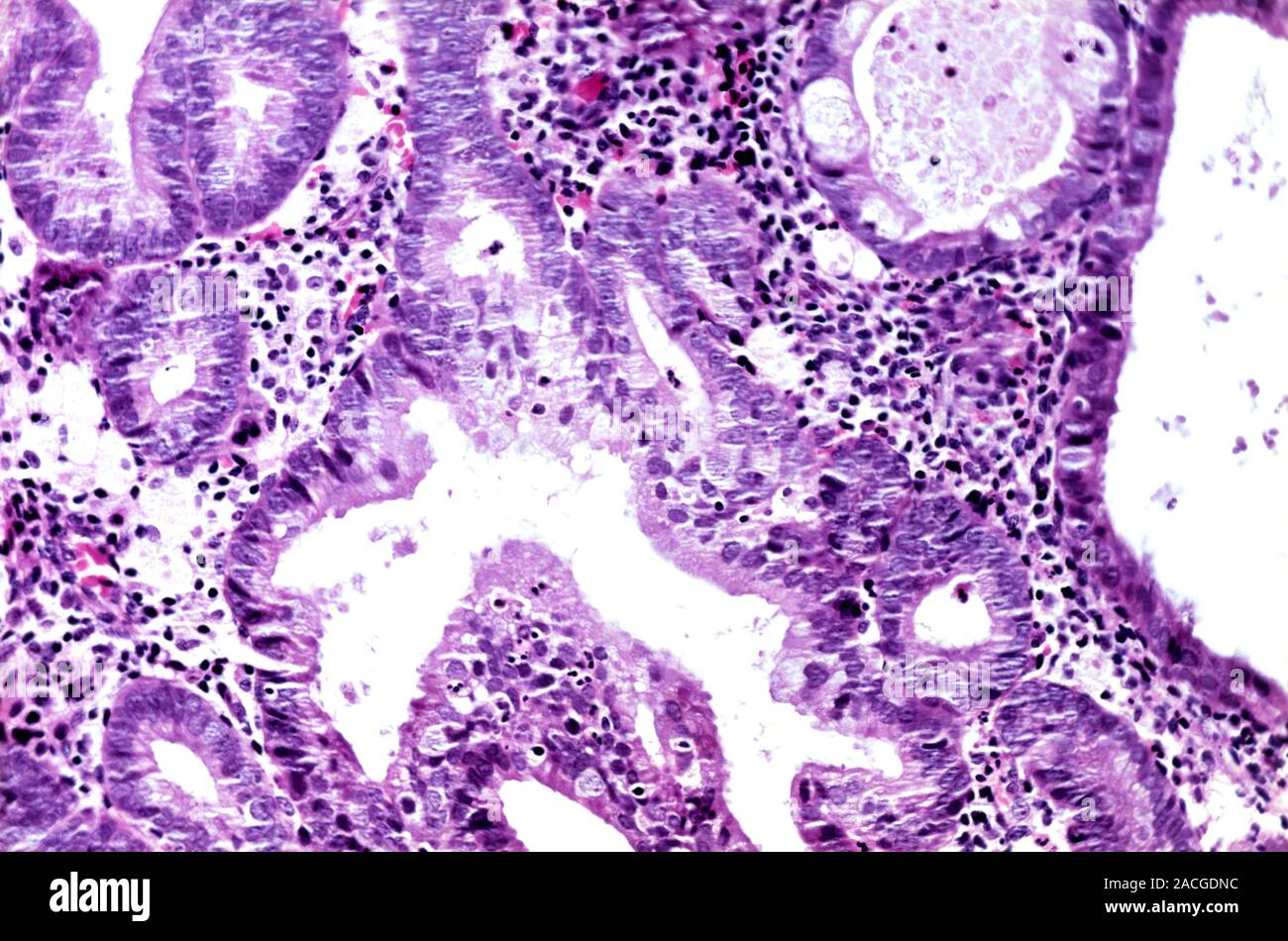 Endometrial hyperplasia. Light micrograph of a section through tissue ...