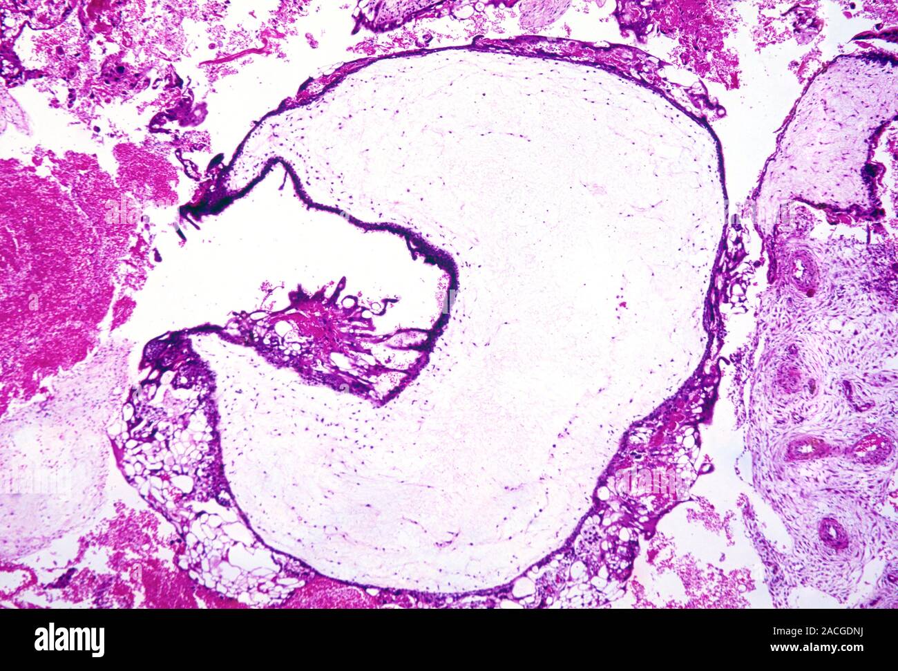 Hydatidiform mole. Light micrograph of a section through tissue from ...
