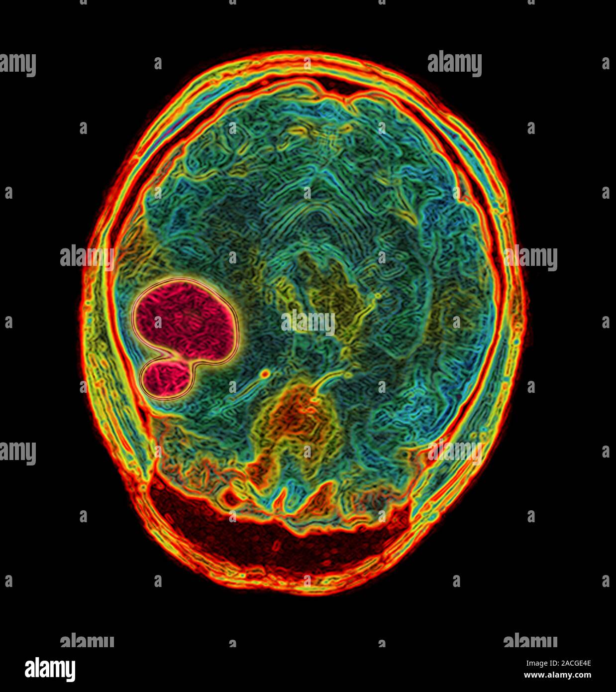 Brain tumour. Coloured magnetic resonance imaging (MRI) scan of an axial (horizontal) section ...