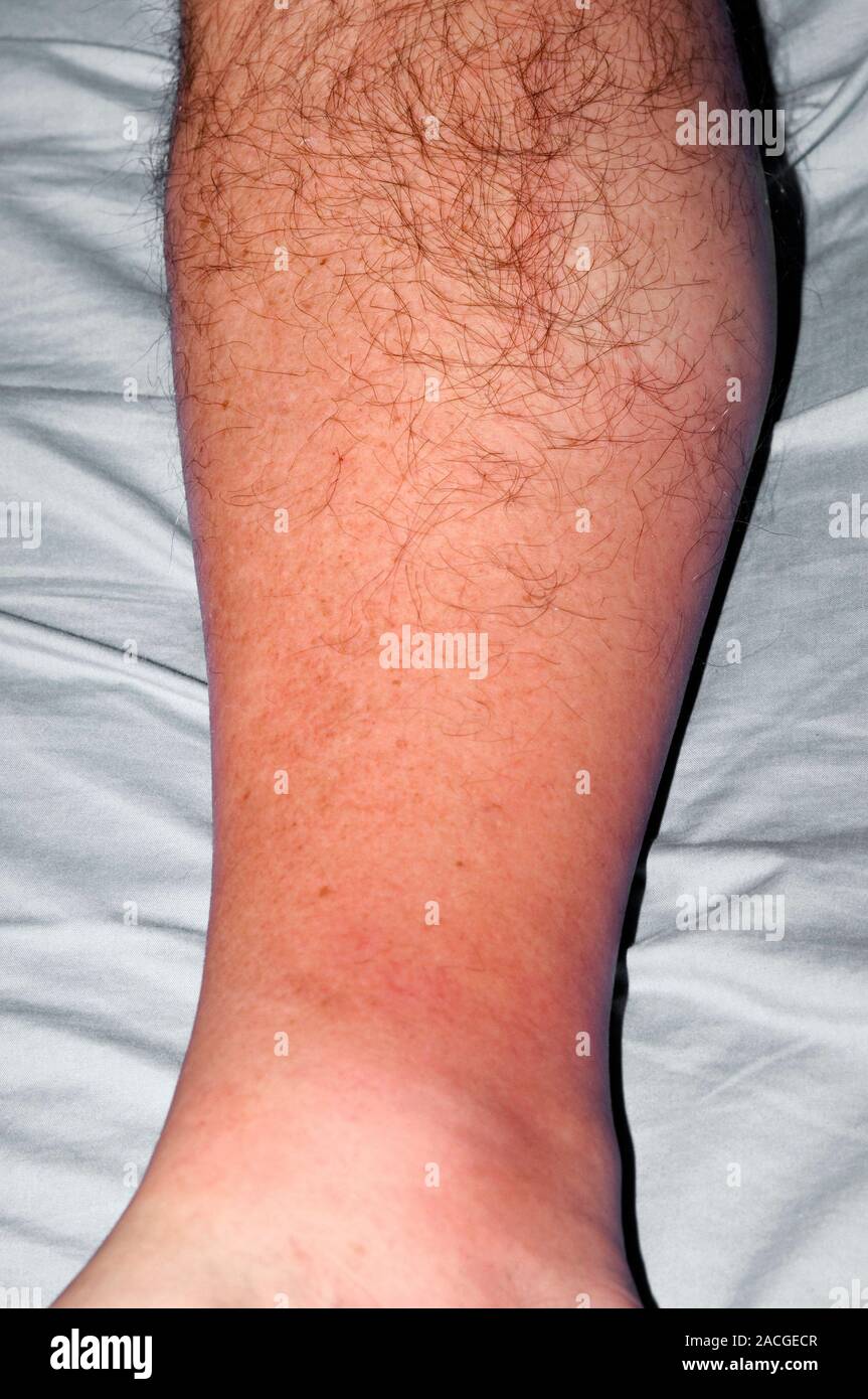 Red and inflamed shin of the leg in a 54 year old male patient showing ...