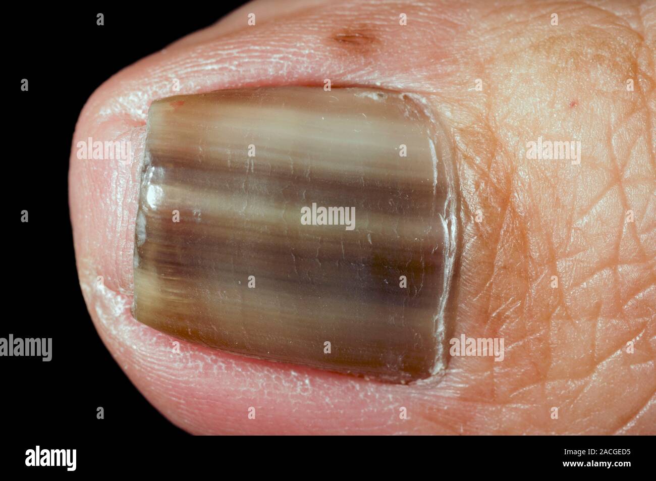 Close-up of the toenail of a 63 year old female patient, showing ...