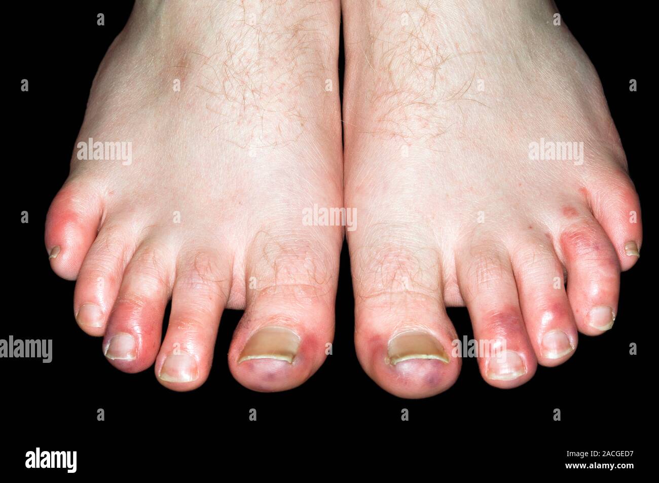 Feet in a 22 year old male patient showing chilblains of the toes ...