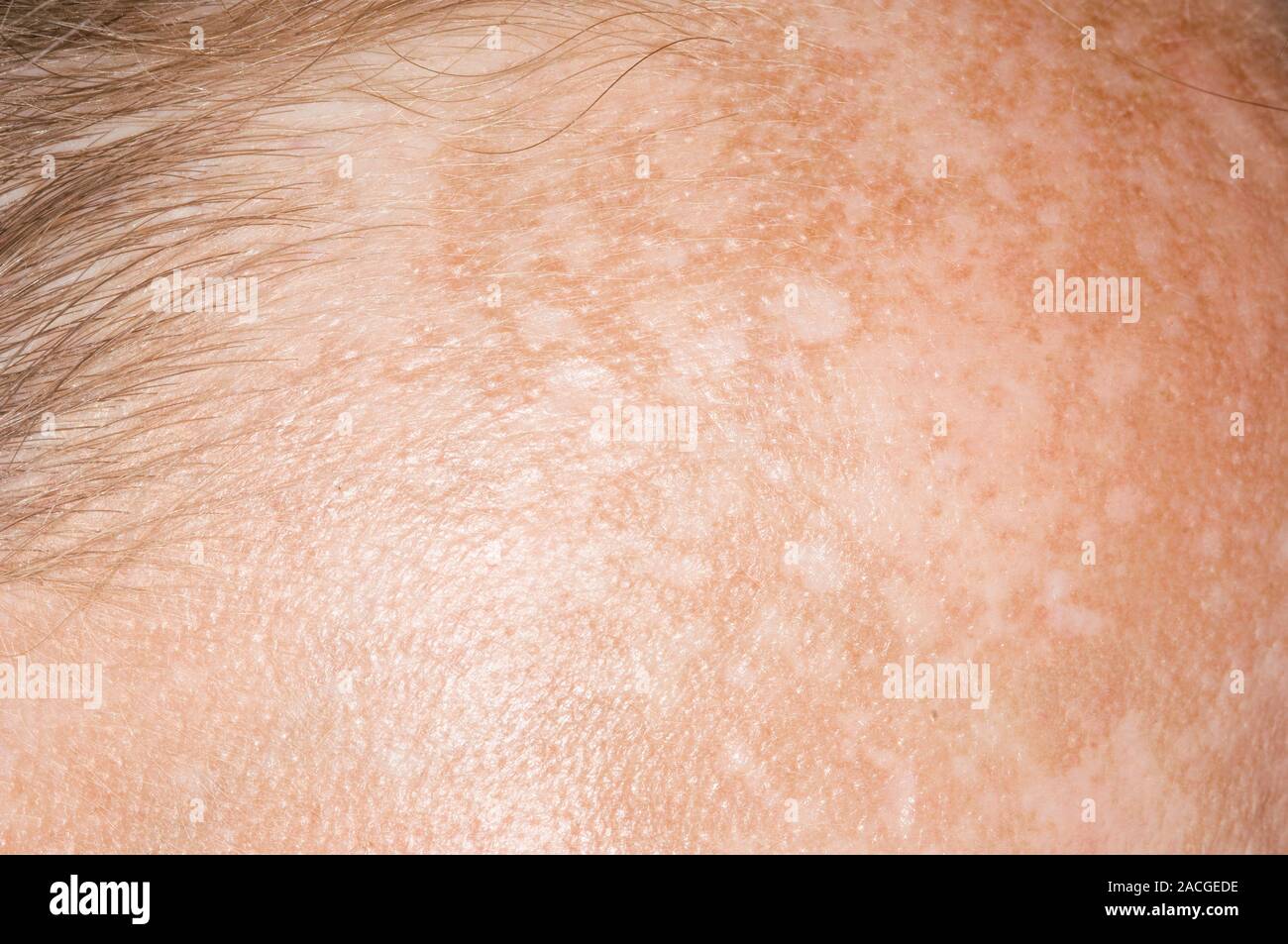 Close-up of the skin of the forehead in a 35 year old female patient ...