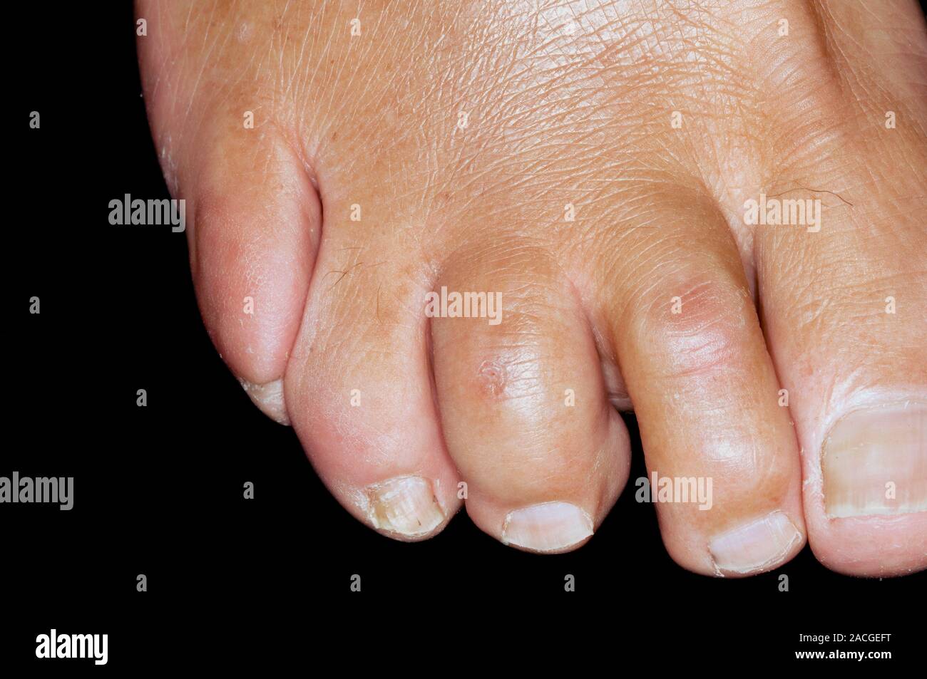 Second and third toes (at centre) in a 70 year old male patient ...