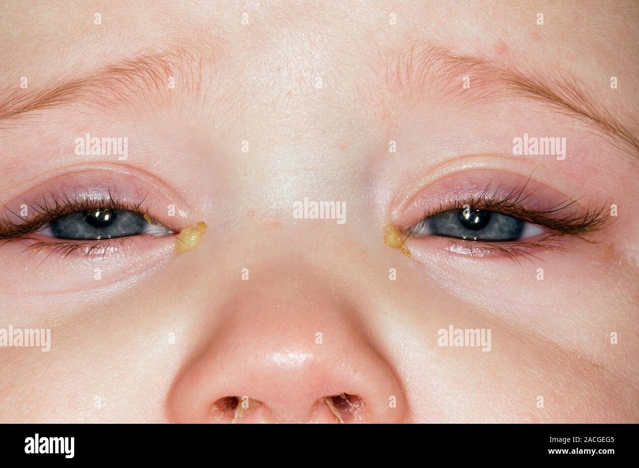 Pus exudate and reddening of the eyes in a 6 month old female child ...