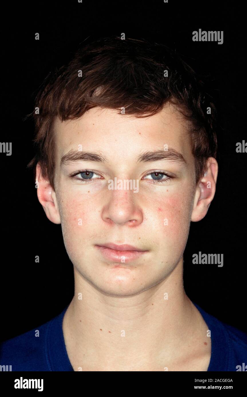 Swelling of the cheek (at right) in a 14 year old male patient due to a ...