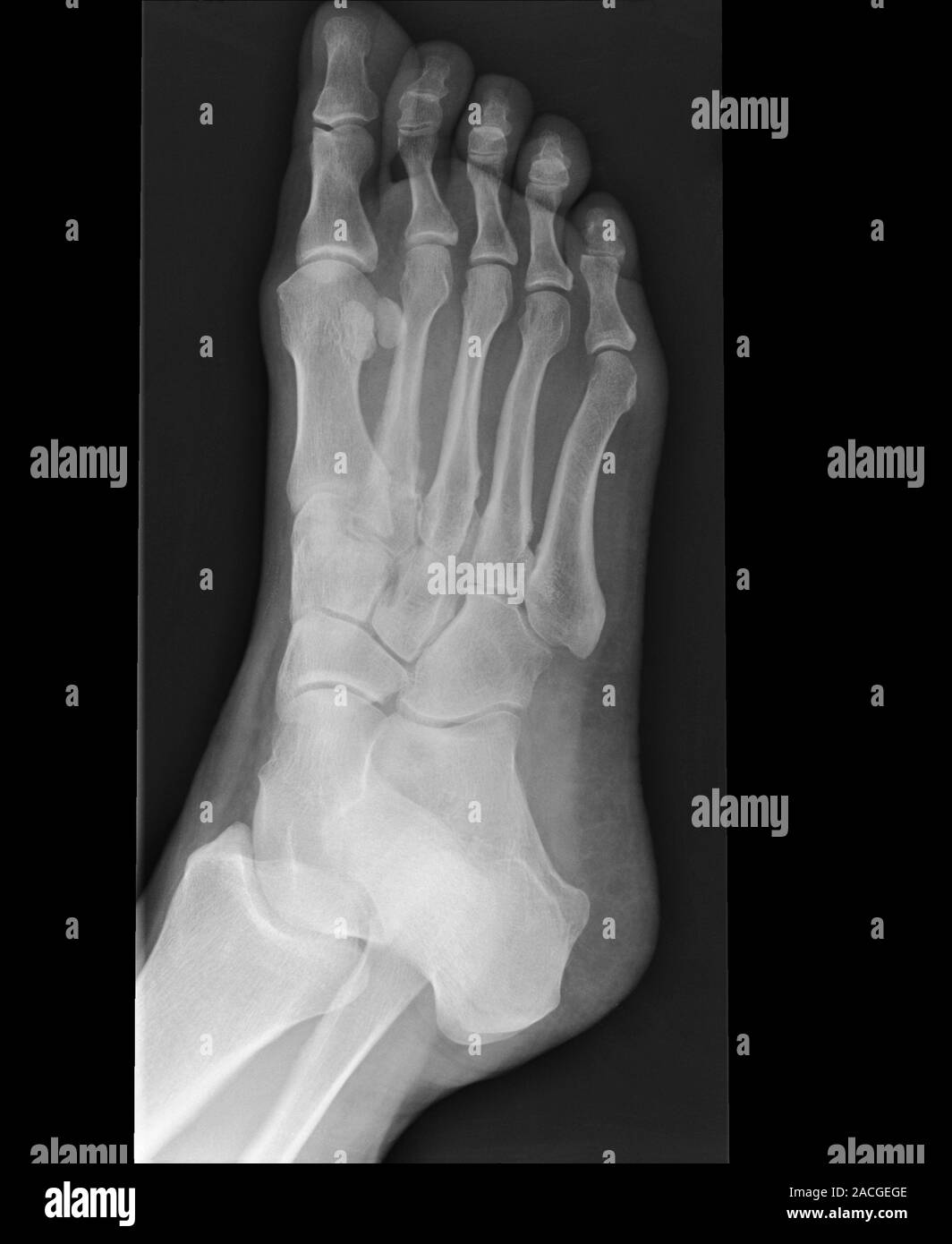 Xray Of Foot Stress Fracture 2nd Metatarsal Stress Fractures