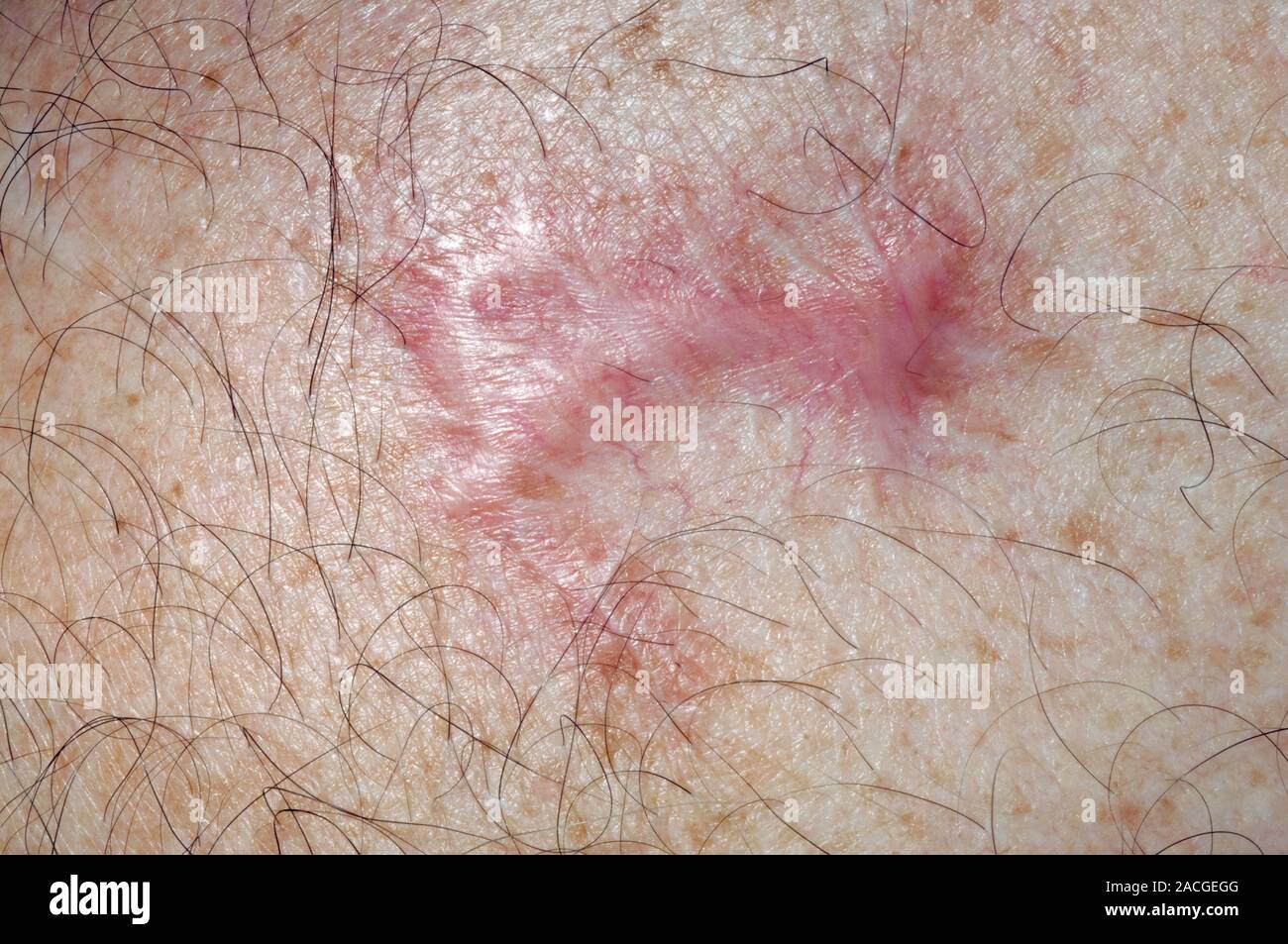 Close-up of a keloid scar on the shoulder of a 64 year old male patient ...